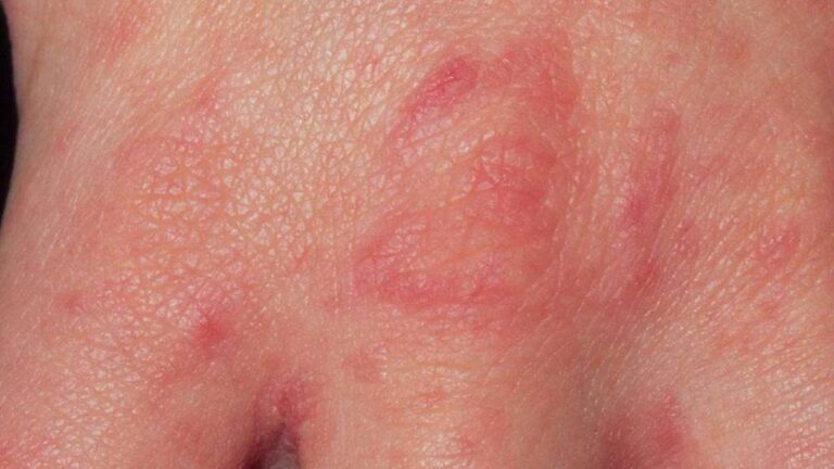 Escabiosis: Causas, Síntomas y Tratamiento - Dossier Interactivo