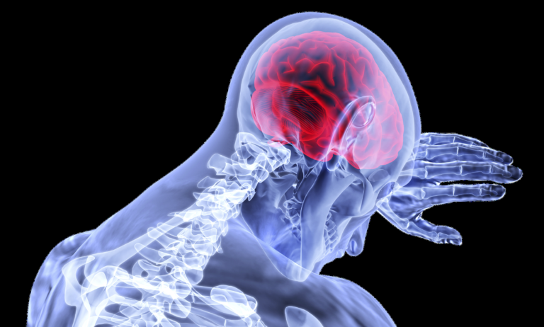 Enfermedad Cerebro Vascular Isquémico: Síntomas y Tratamiento